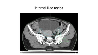 TARGET DELINEATION IN RECTUM CANCER BY DR KANHU | PPTX
