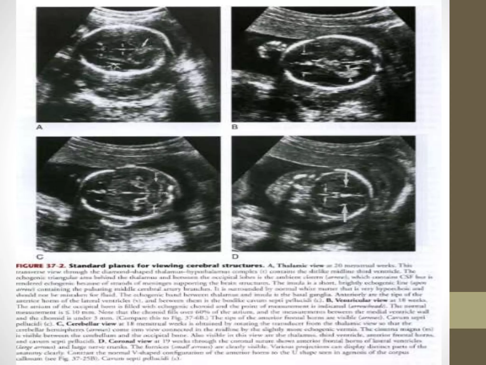 Target scan for fetal anomalies | PPTX