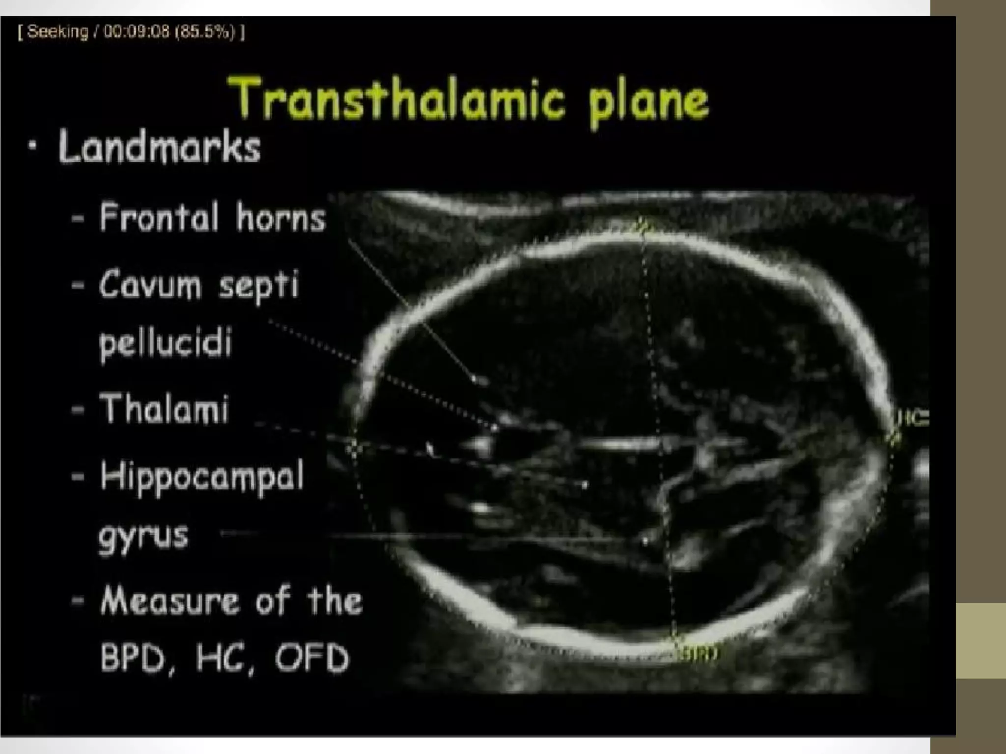 Target scan for fetal anomalies | PPTX