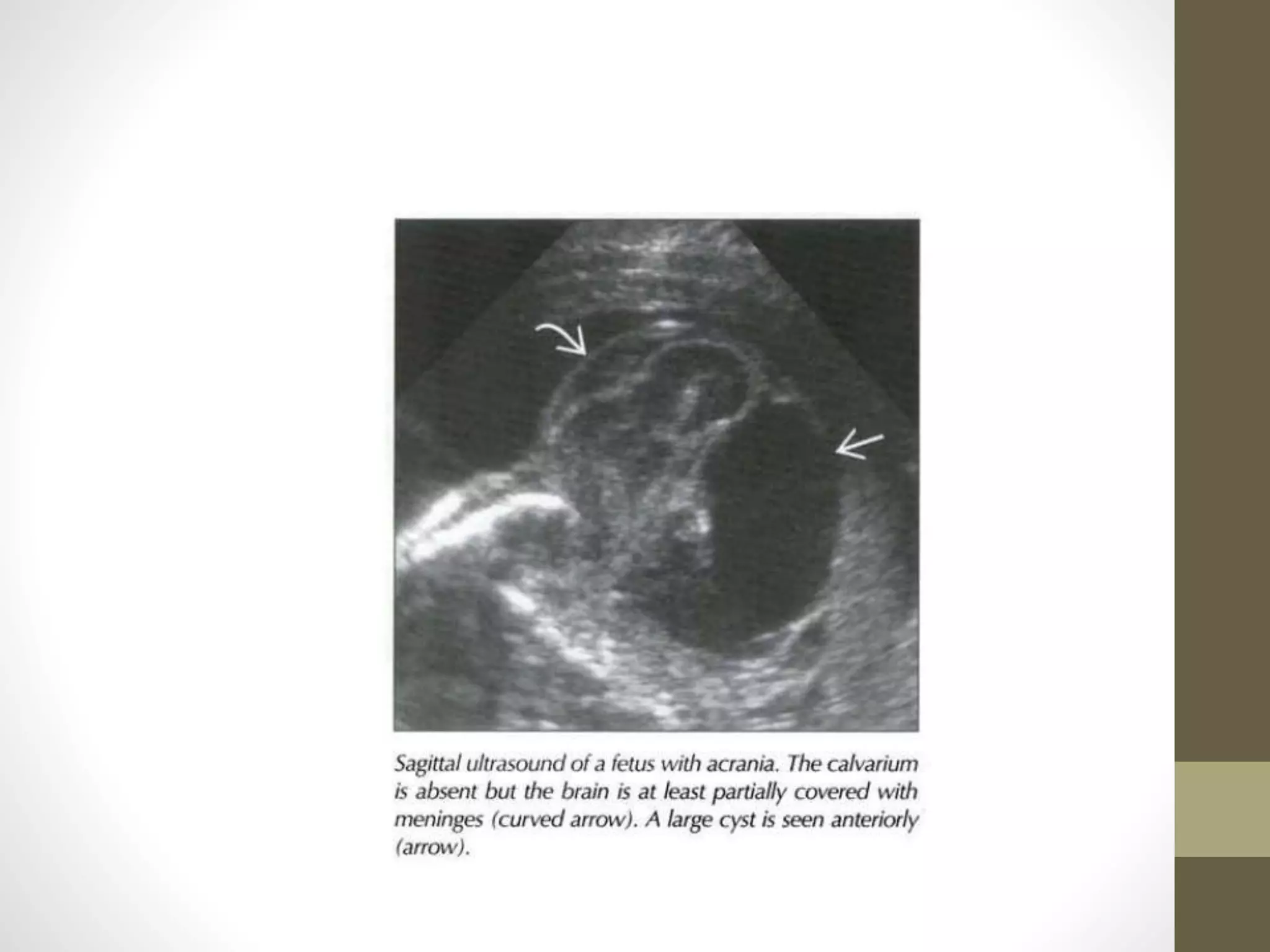 Target scan for fetal anomalies | PPTX