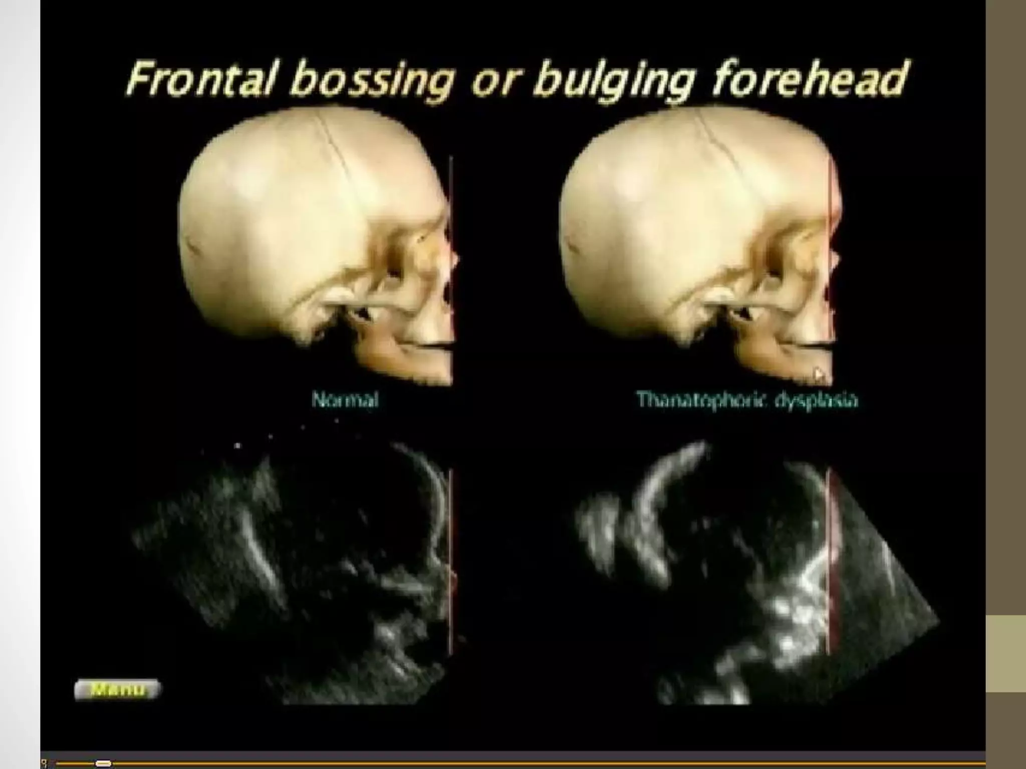 Target scan for fetal anomalies | PPTX