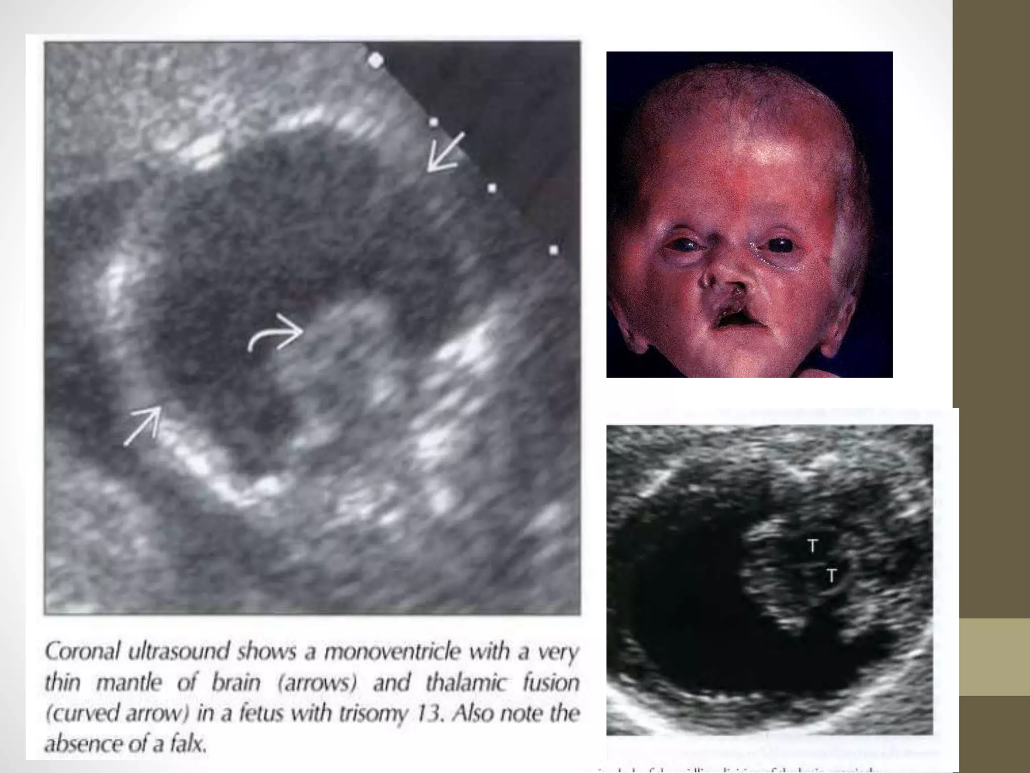 Target scan for fetal anomalies | PPT