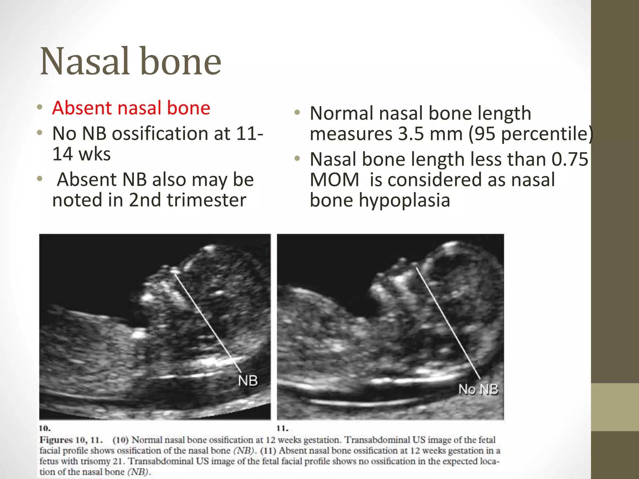 Target scan for fetal anomalies | PPTX