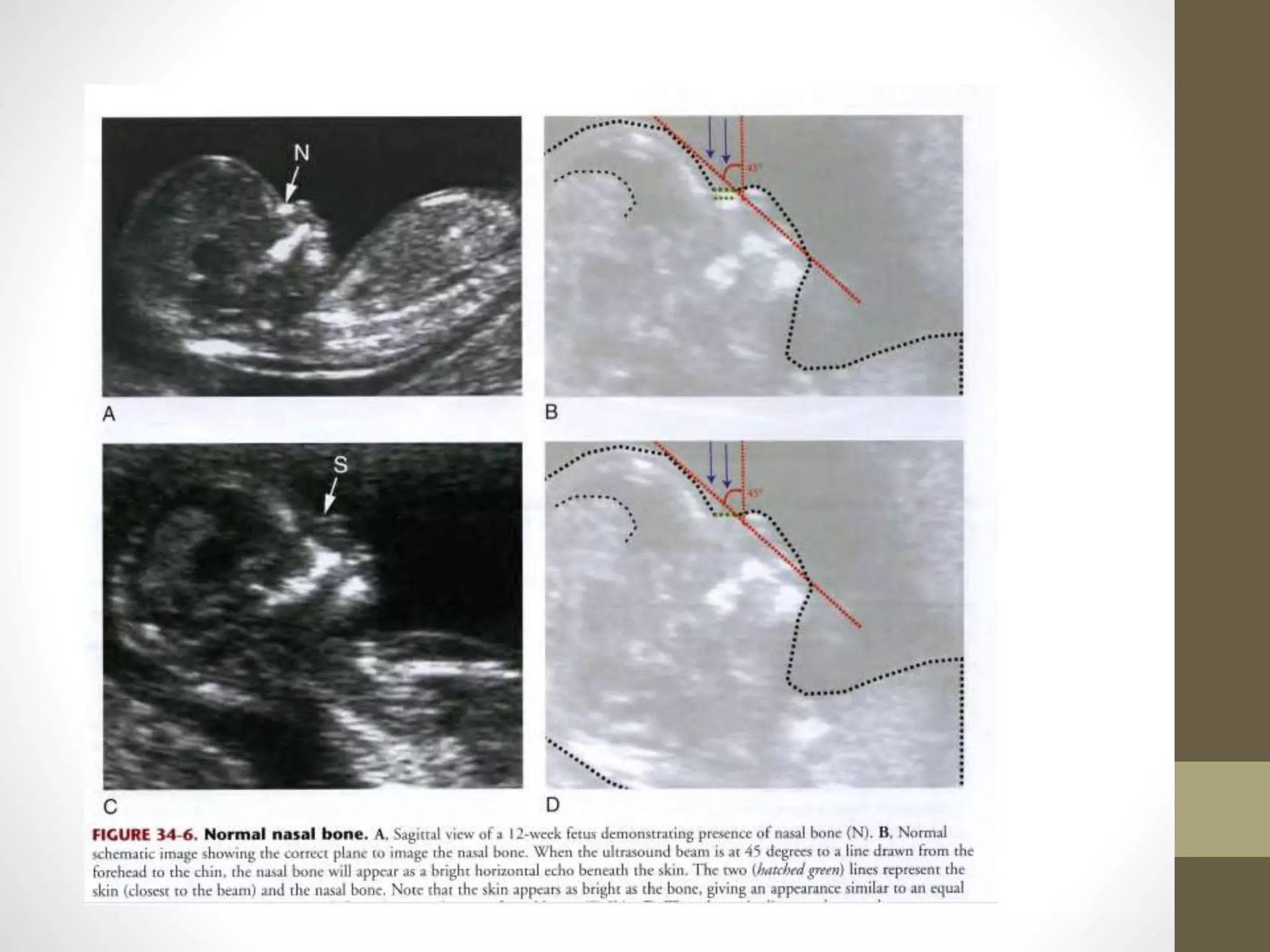 Target scan for fetal anomalies | PPTX