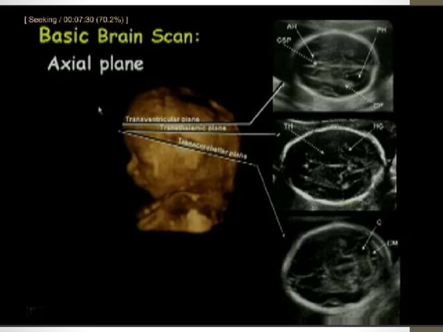 Target scan for fetal anomalies | PPT