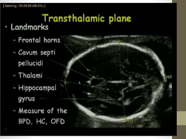 Target scan for fetal anomalies | PPT