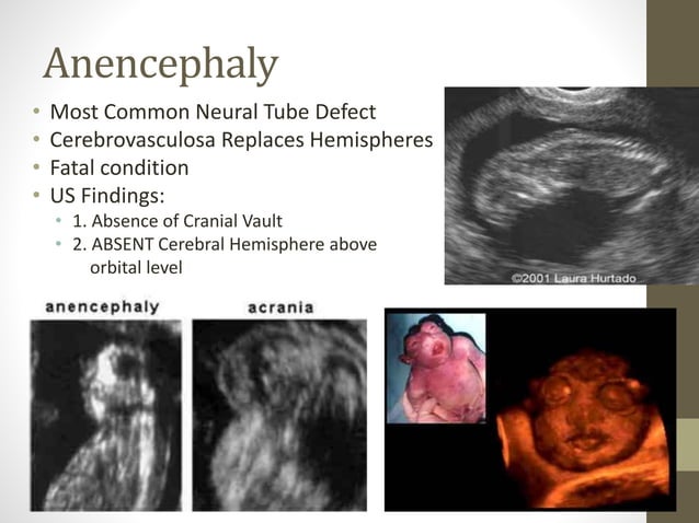 Target scan for fetal anomalies | PPT