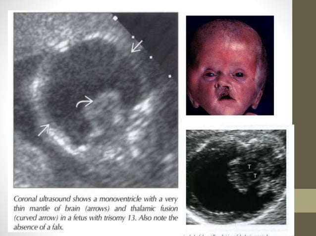 Target scan for fetal anomalies | PPT