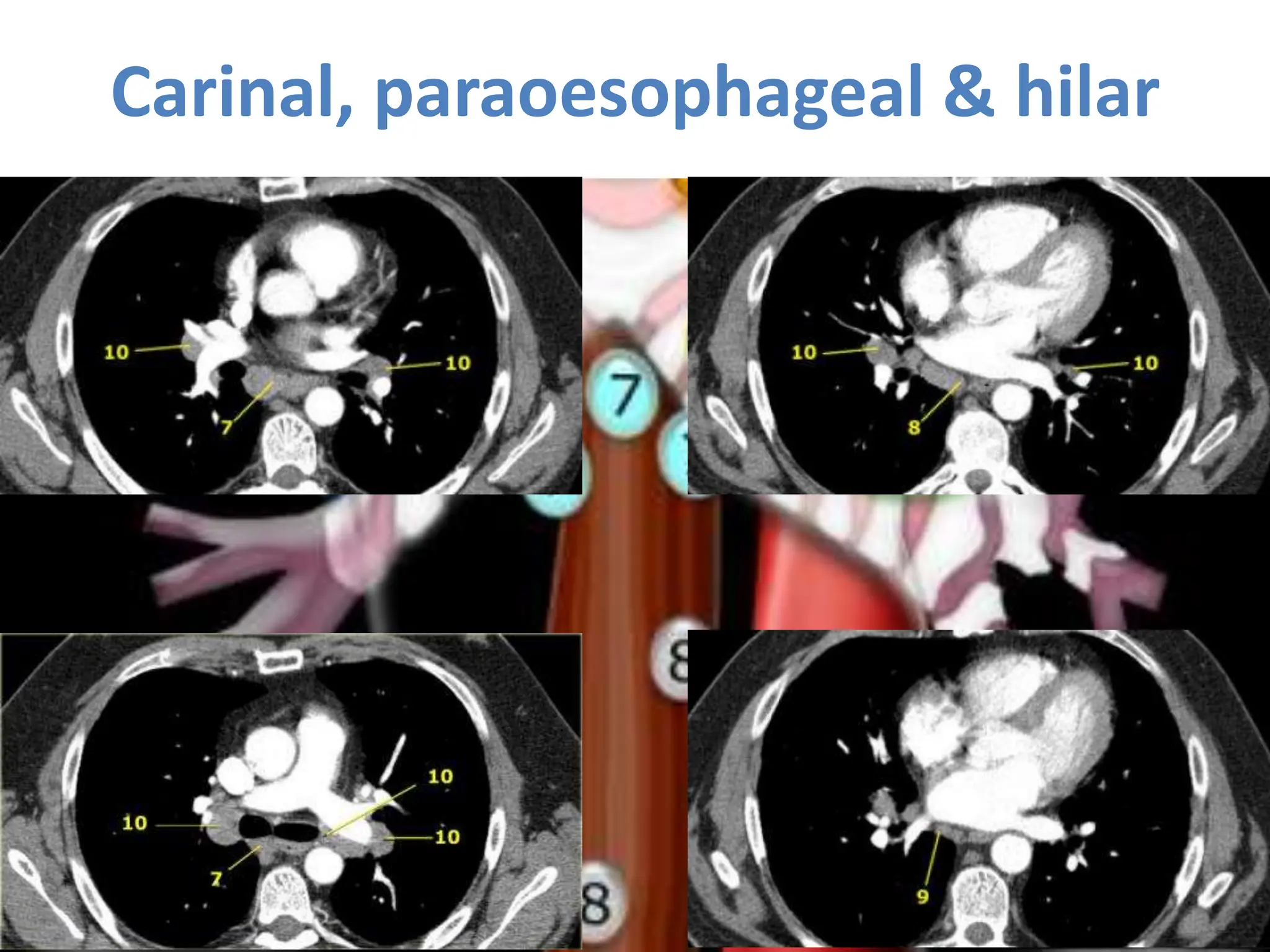 Target Delineation Of Thoracic Nodal Station Pptx