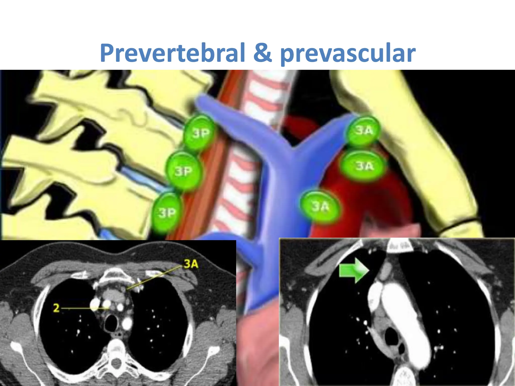 TARGET DELINEATION OF THORACIC NODAL. STATION | PPTX