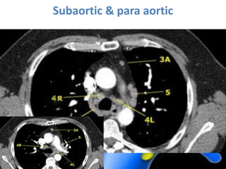 TARGET DELINEATION OF THORACIC NODAL. STATION | PPTX