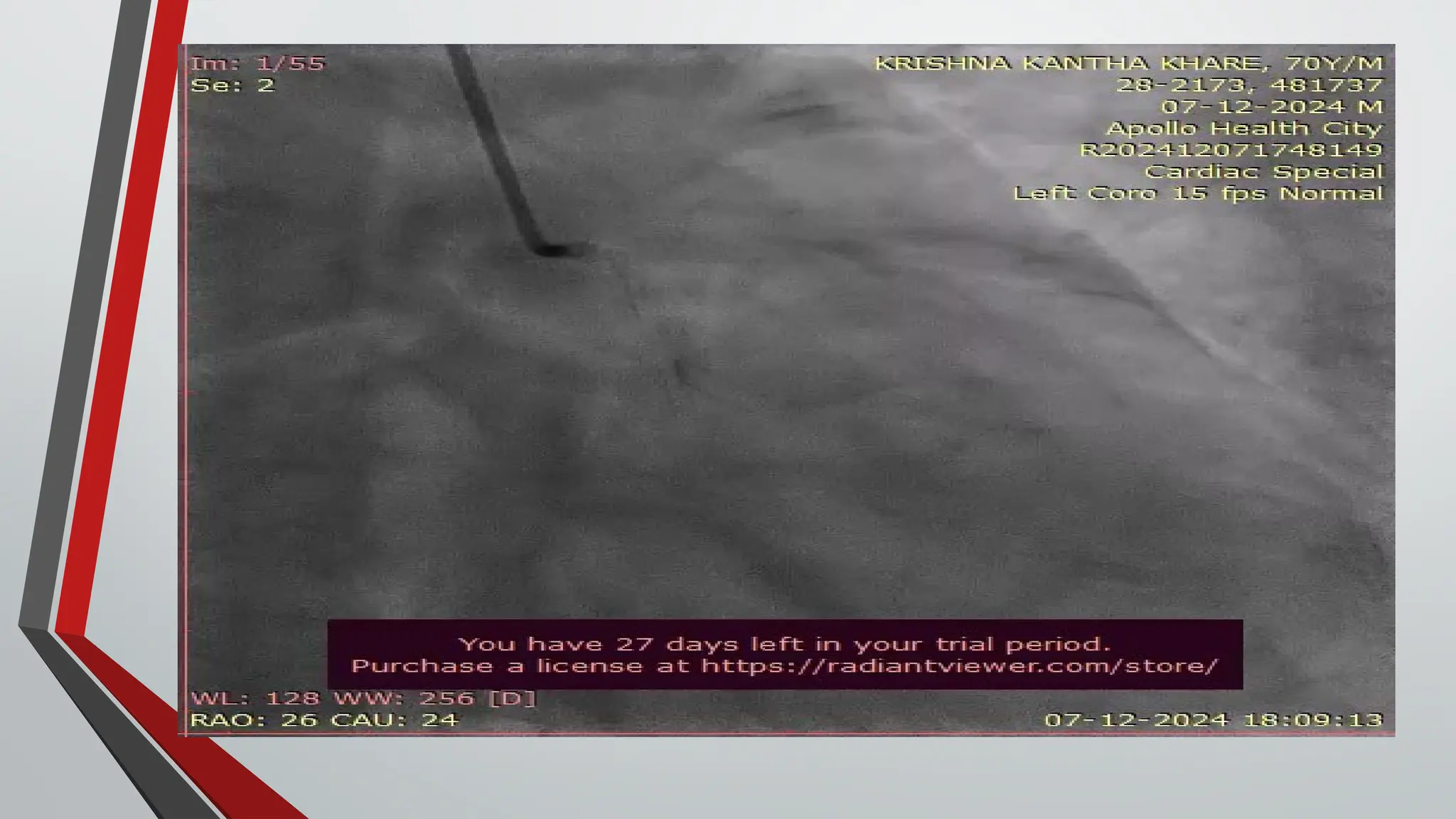 TARGET VESSEL PCI VS MULTIVESSEL PCI IN PAMI.pptx