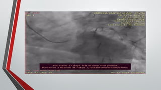 TARGET VESSEL PCI VS MULTIVESSEL PCI IN PAMI.pptx