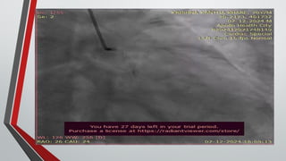 TARGET VESSEL PCI VS MULTIVESSEL PCI IN PAMI.pptx