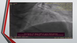 TARGET VESSEL PCI VS MULTIVESSEL PCI IN PAMI.pptx