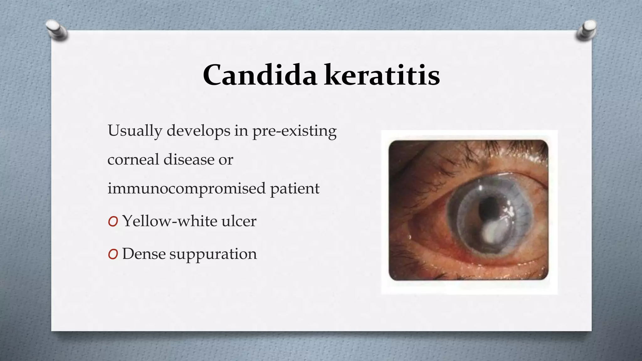 Corneal Diseases / abnormalities | PPTX