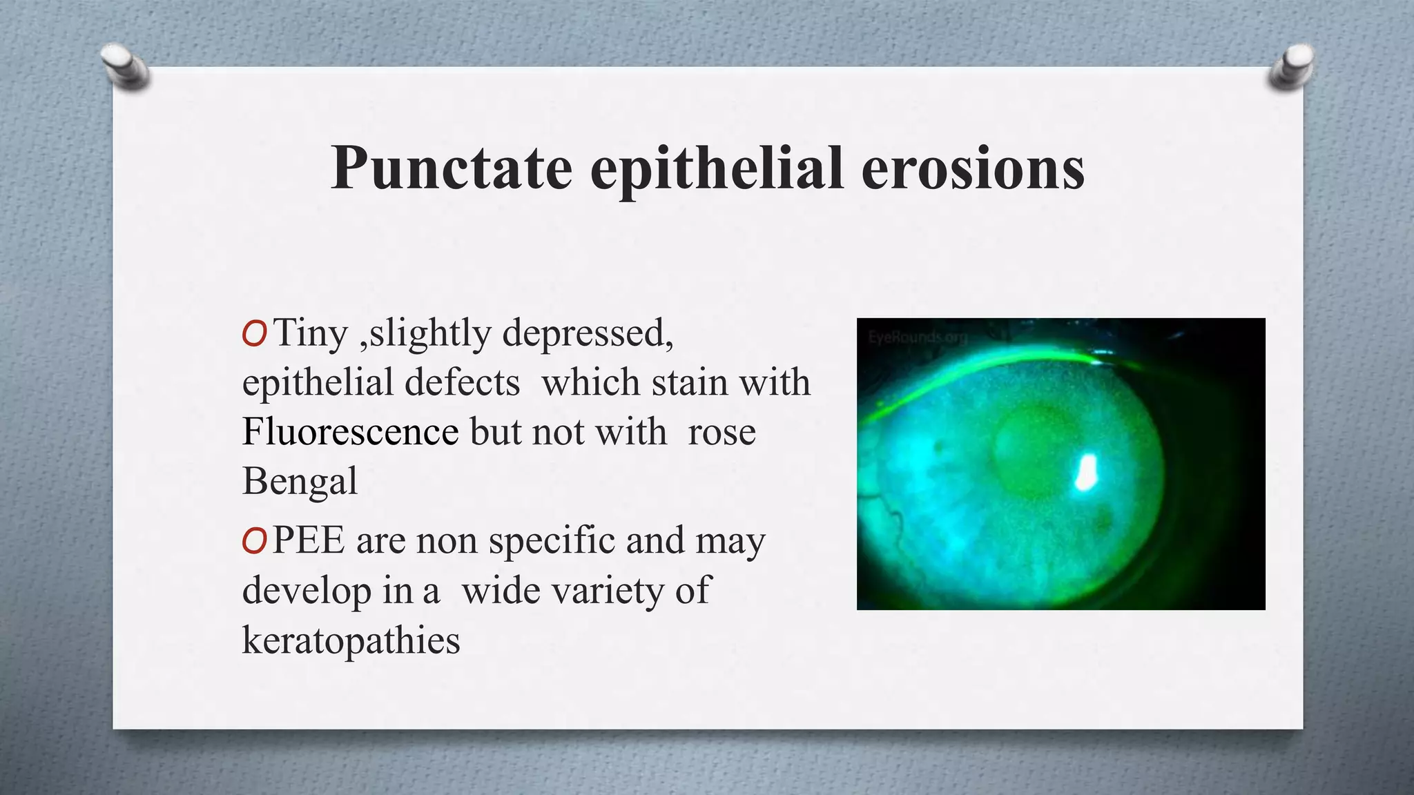 Corneal Diseases / abnormalities | PPTX