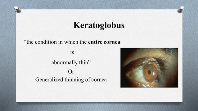 Corneal Diseases / abnormalities | PPTX