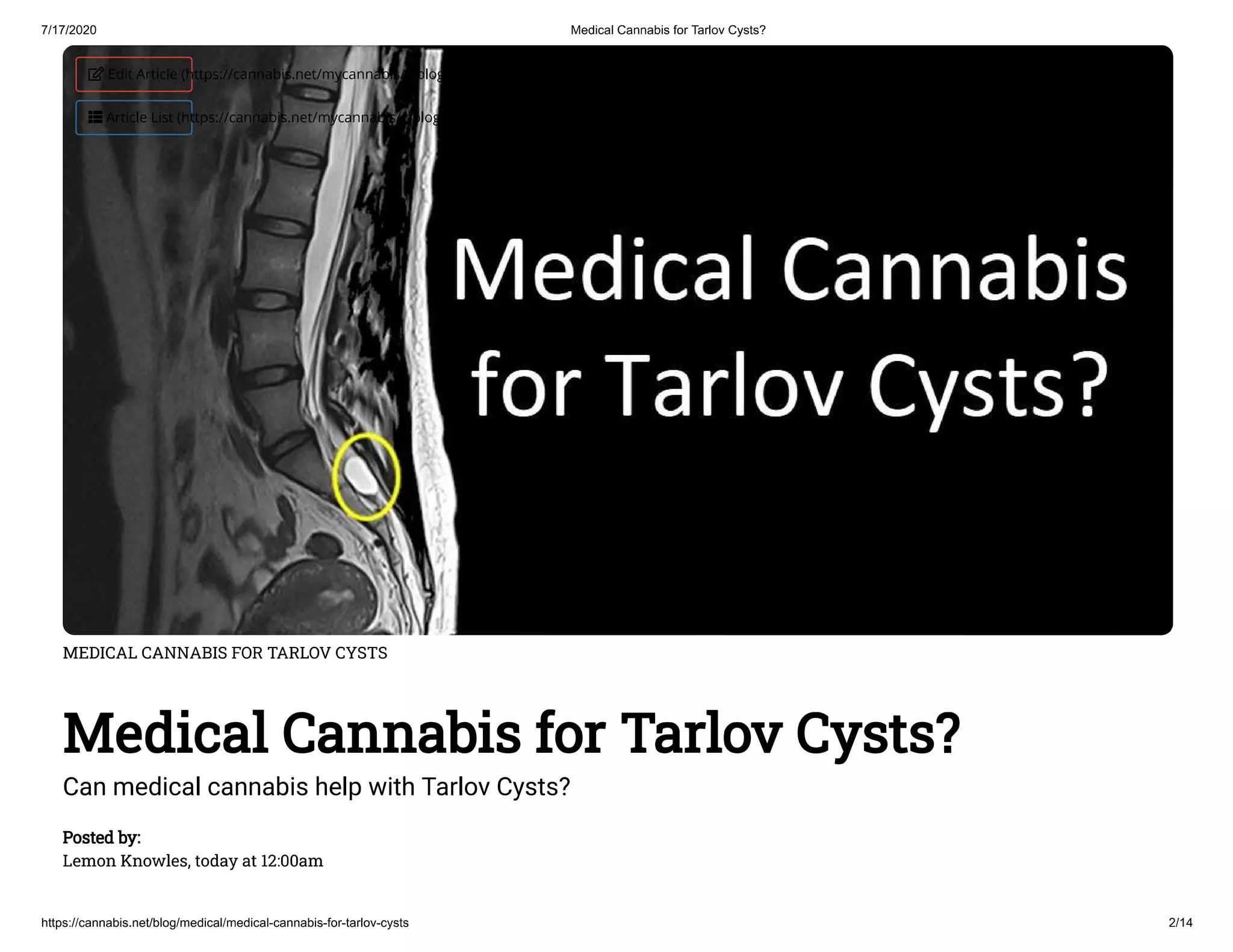 Is Medical Marijuana for Tarlov Cysts? | PDF