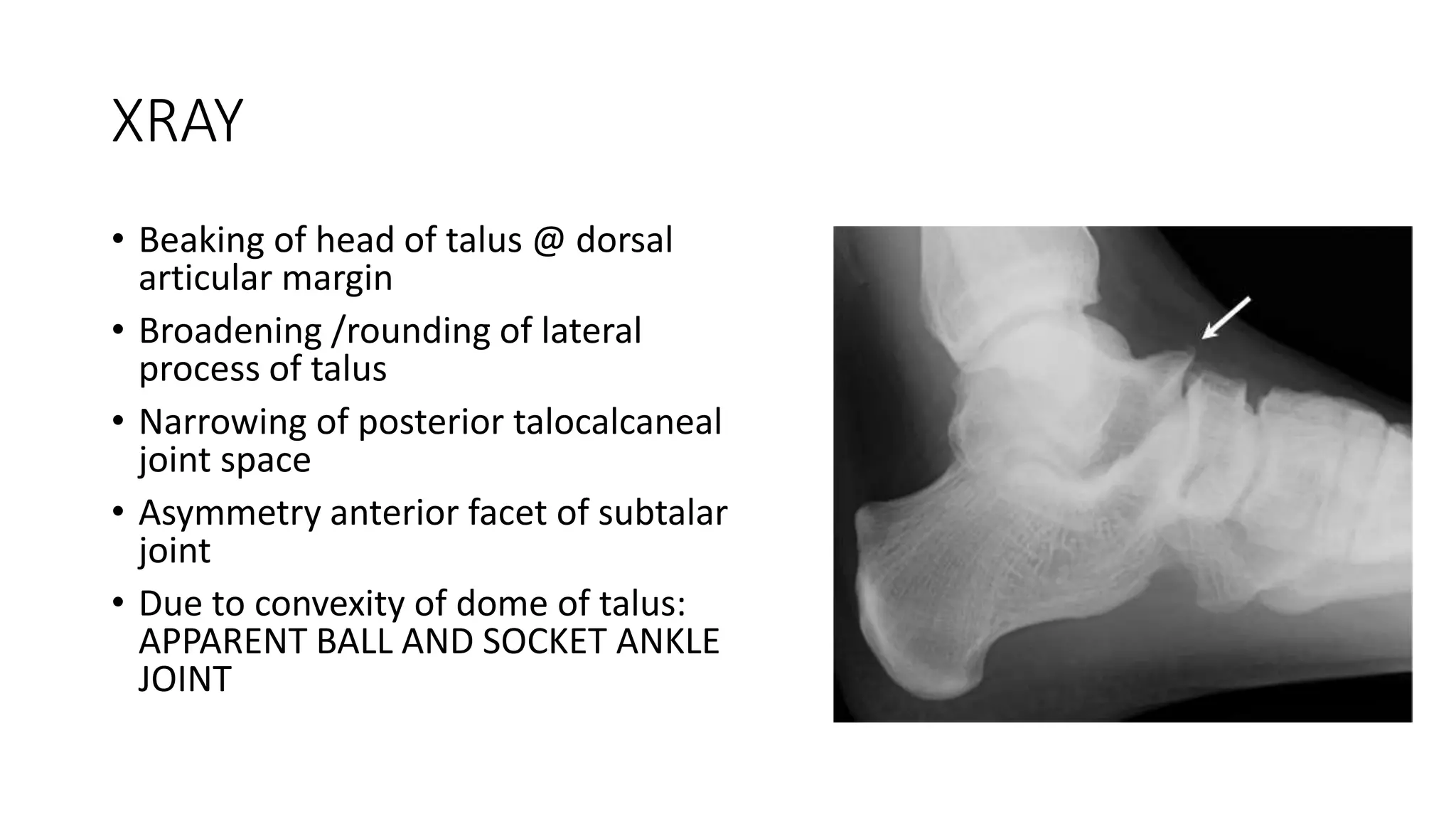 Tarsal coalition | PPTX