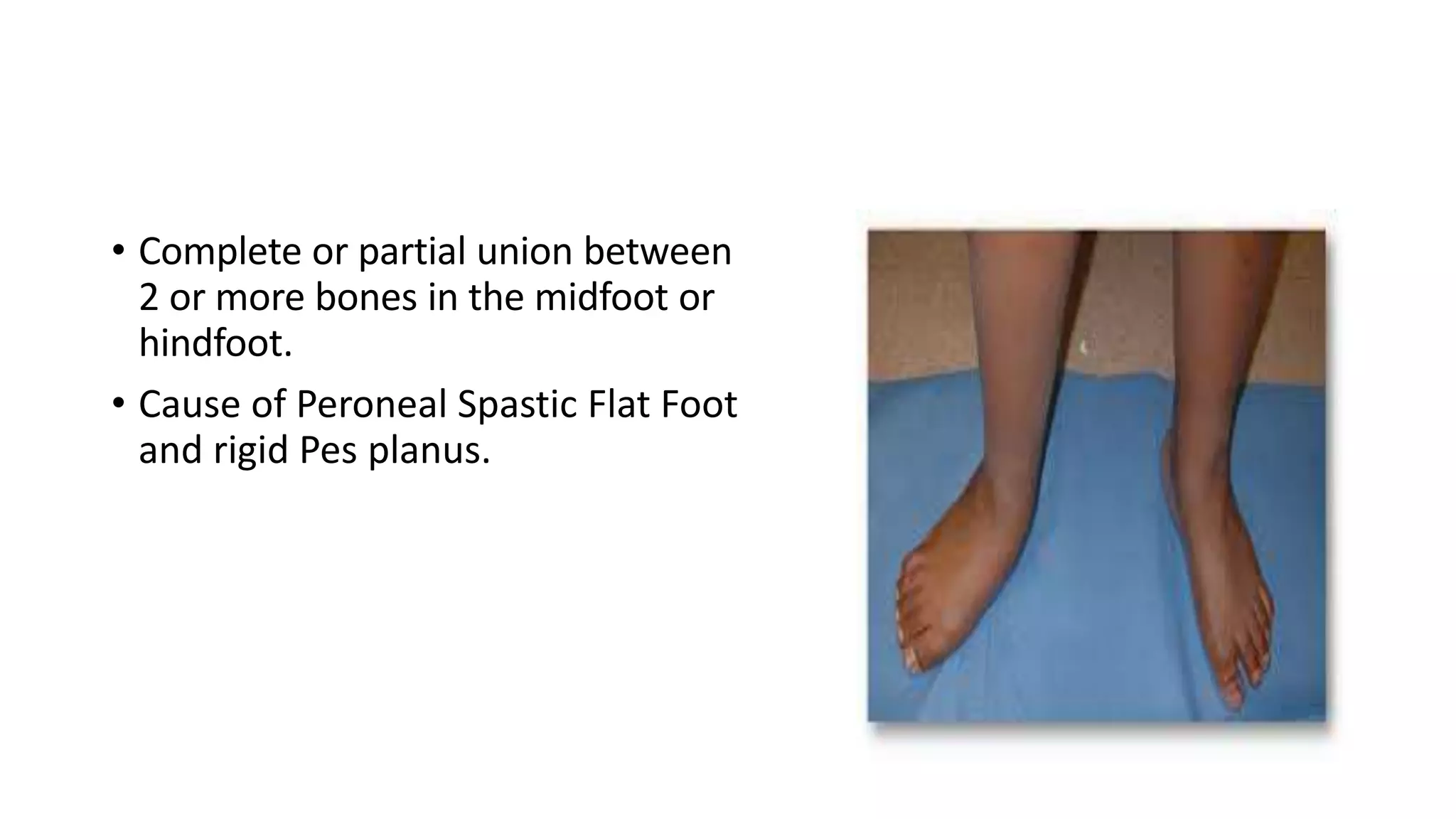 Tarsal coalition | PPTX