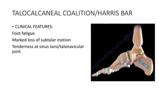 Tarsal coalition | PPTX