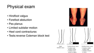 Tarsal coalition | PPTX