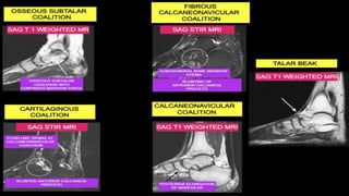 Talocalcaneal Coalition Mri