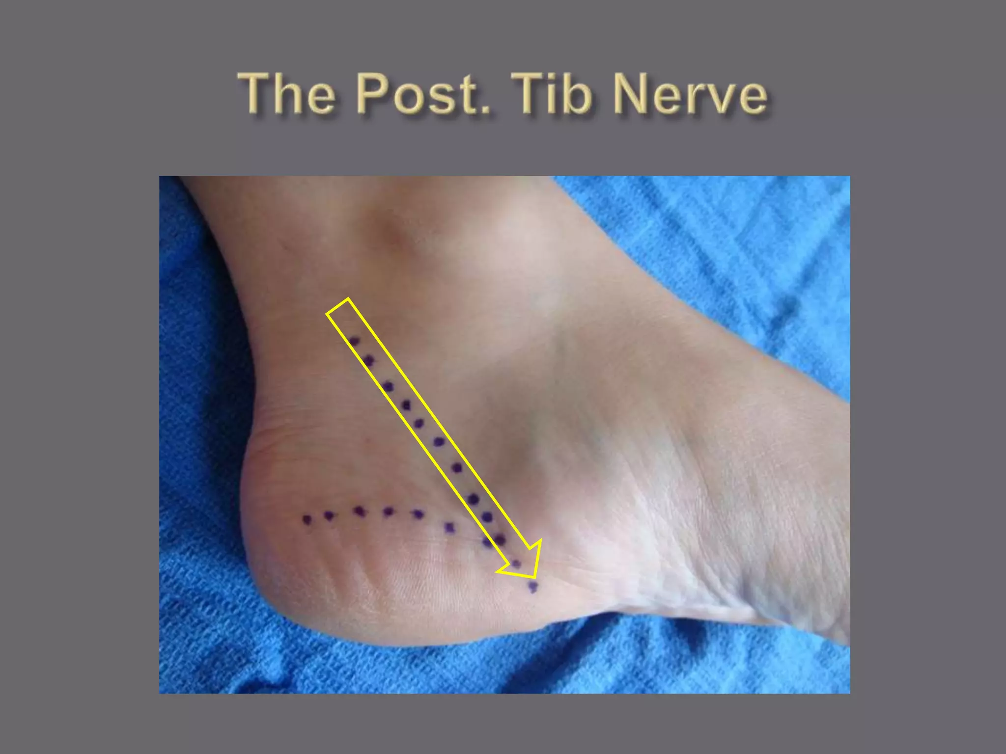 Tarsal Tunnel Incision | PPTX