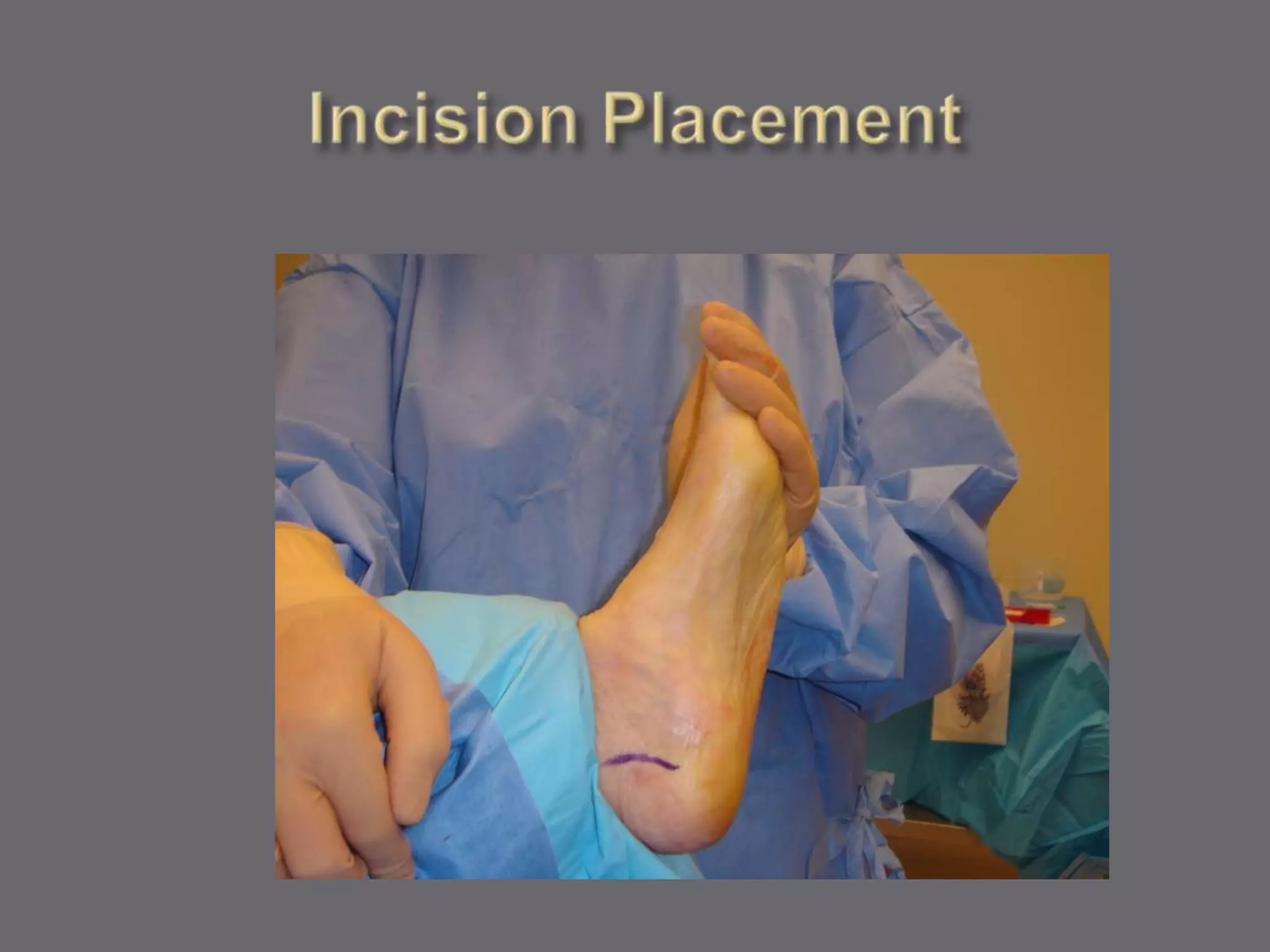 Tarsal Tunnel Incision | PPTX
