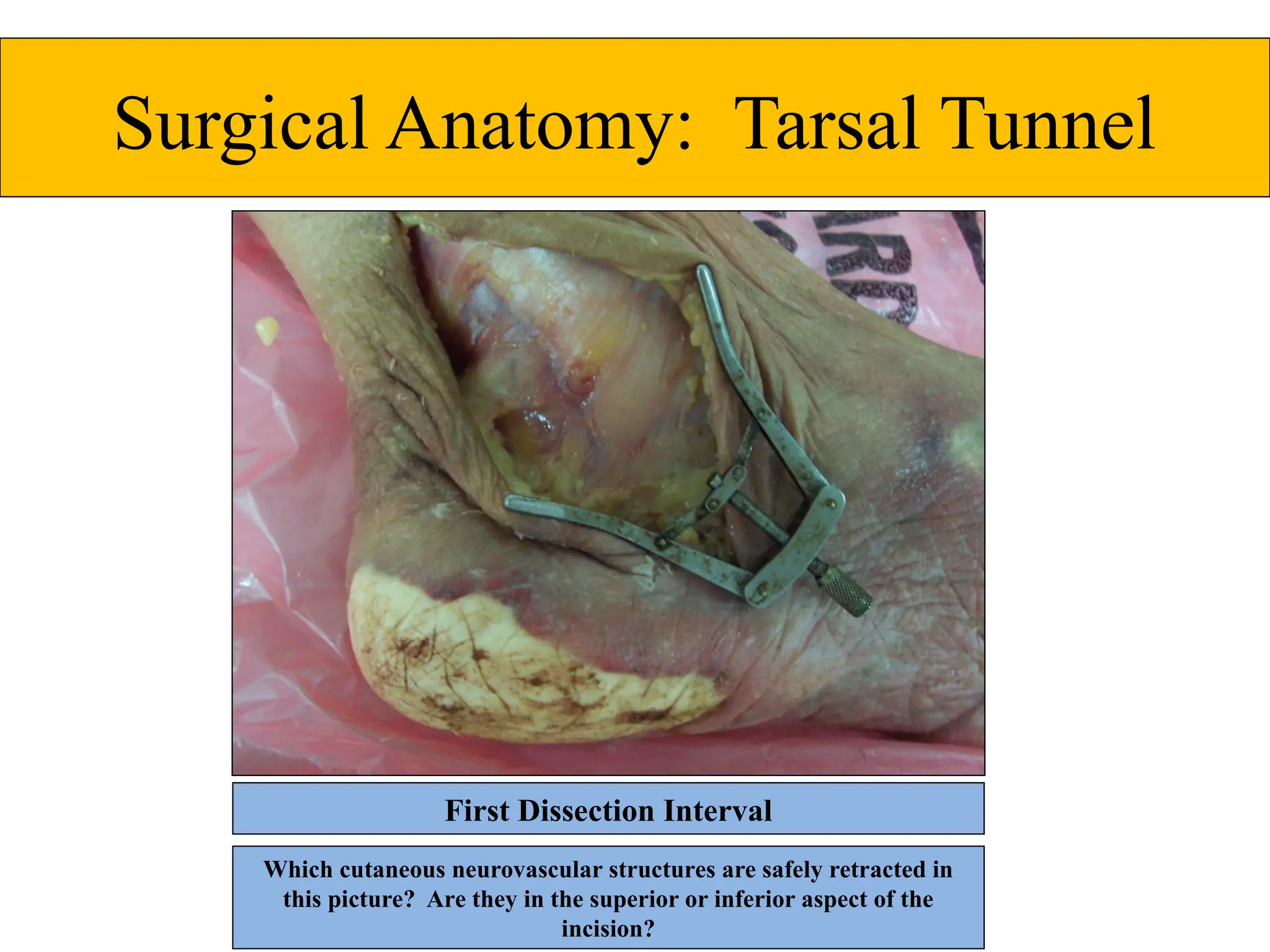 Tarsal Tunnel Surgical Anatomy.ppt.powerpoint presentation | PPTX