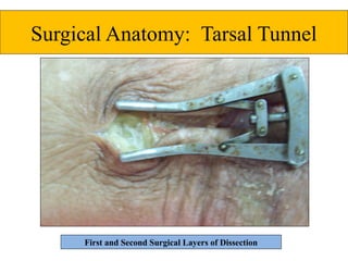 Tarsal Tunnel Surgical Anatomy.ppt.powerpoint presentation | PPTX