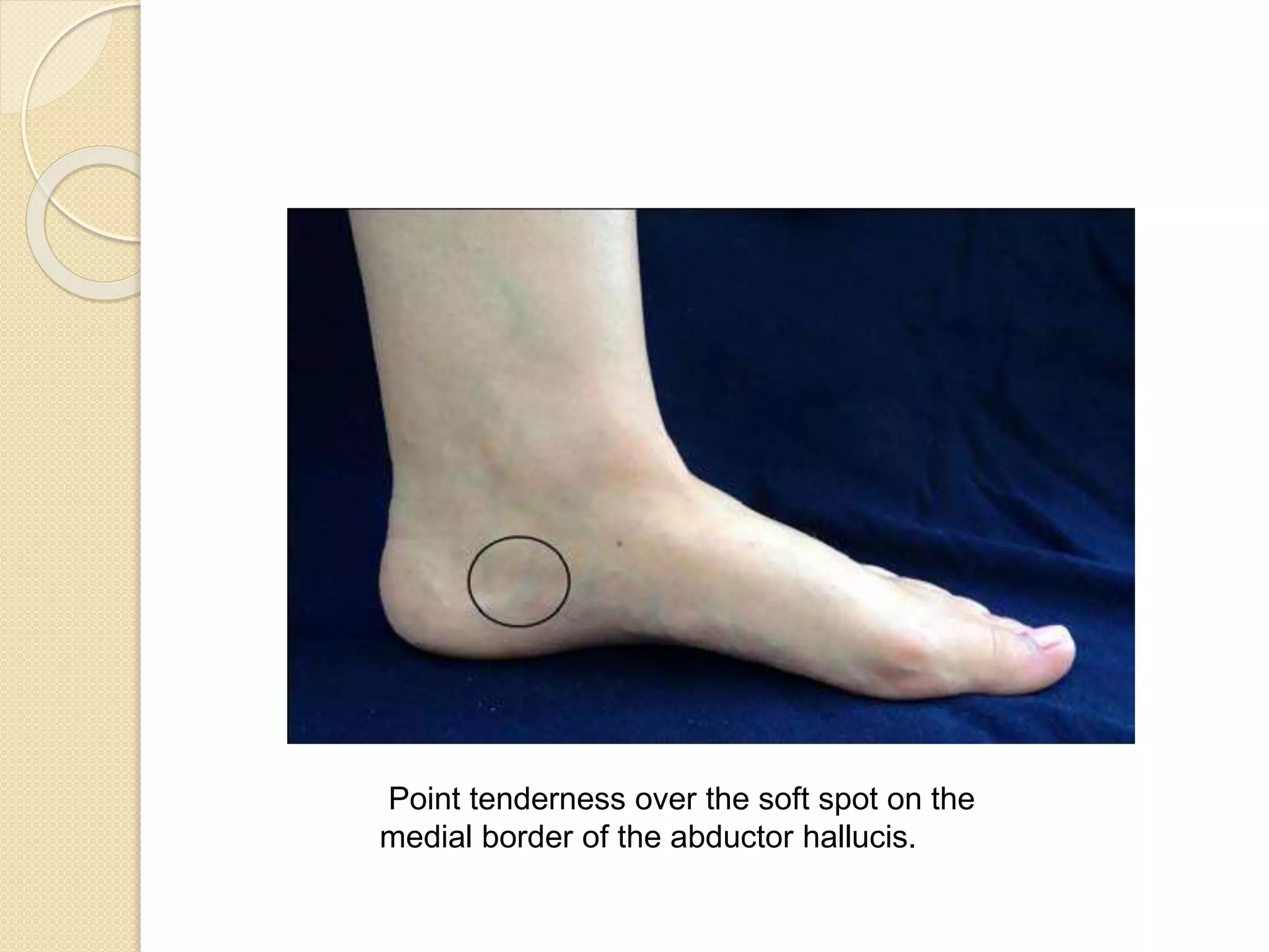 Tarsal tunnel syndrome | PPTX