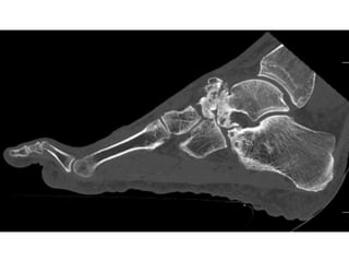 Tarsal Tunnel Syndrome anatomy and management | PDF