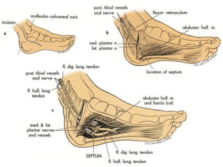 Tarsal Tunnel Syndrome anatomy and management | PDF
