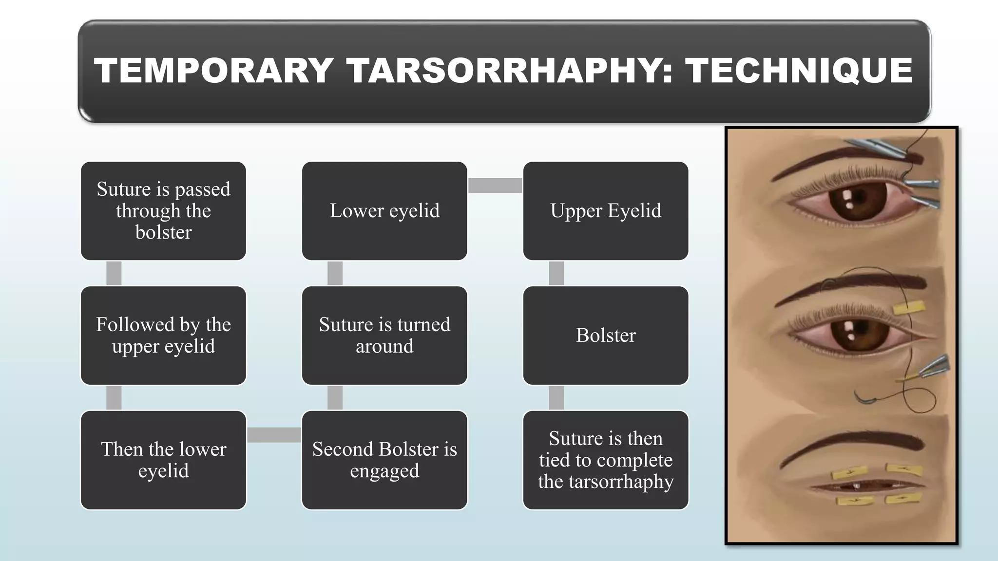 Tarsorrhaphy.pptx