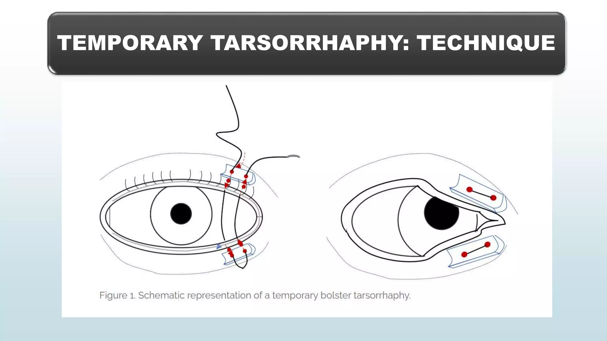 Tarsorrhaphy.pptx