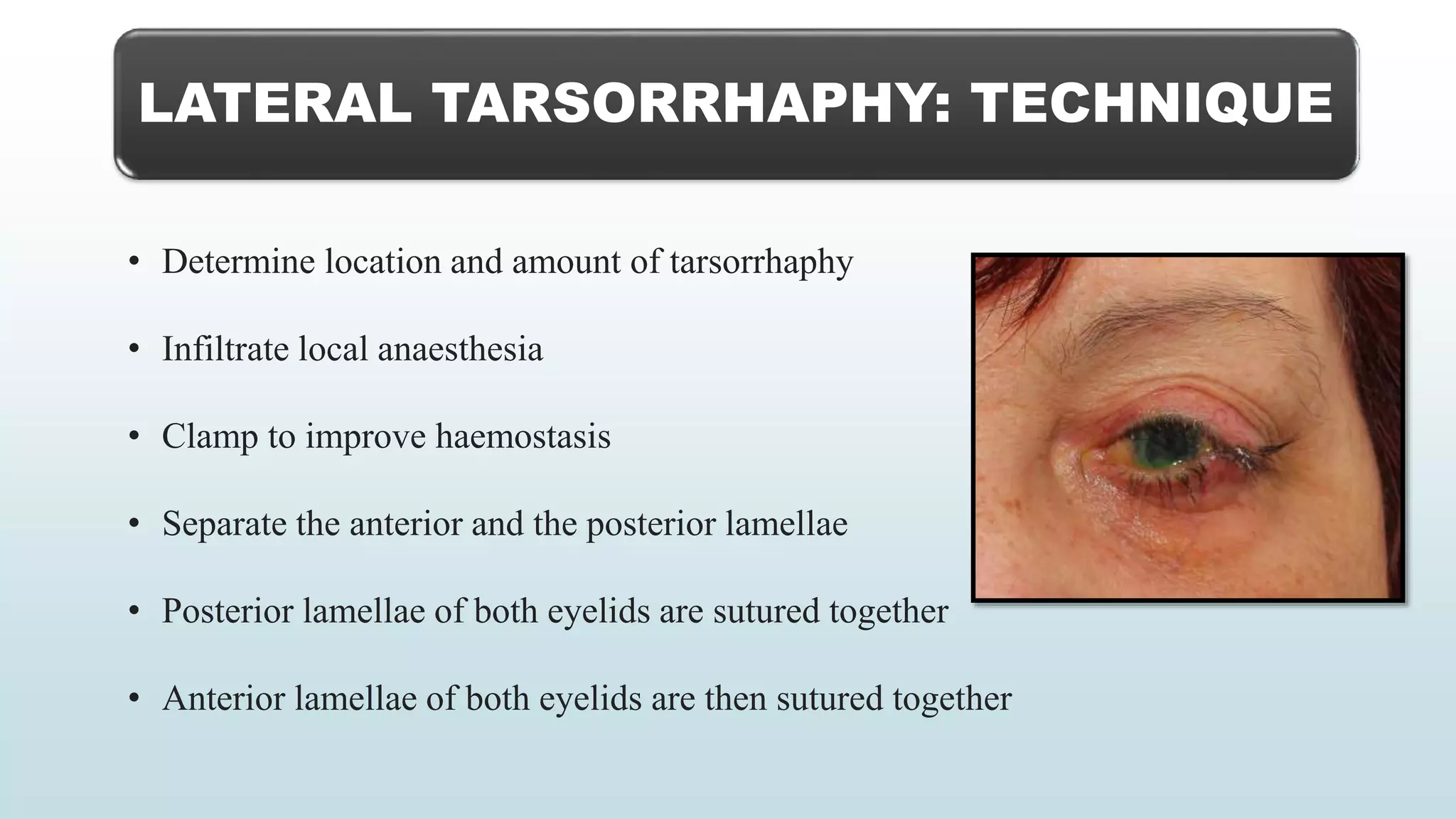 Tarsorrhaphy.pptx