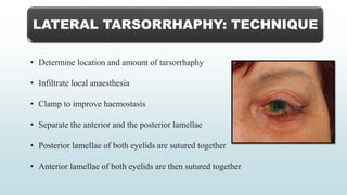 Tarsorrhaphy.pptx