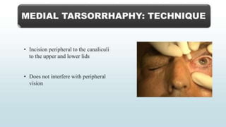 Tarsorrhaphy clinical features and management | PPTX