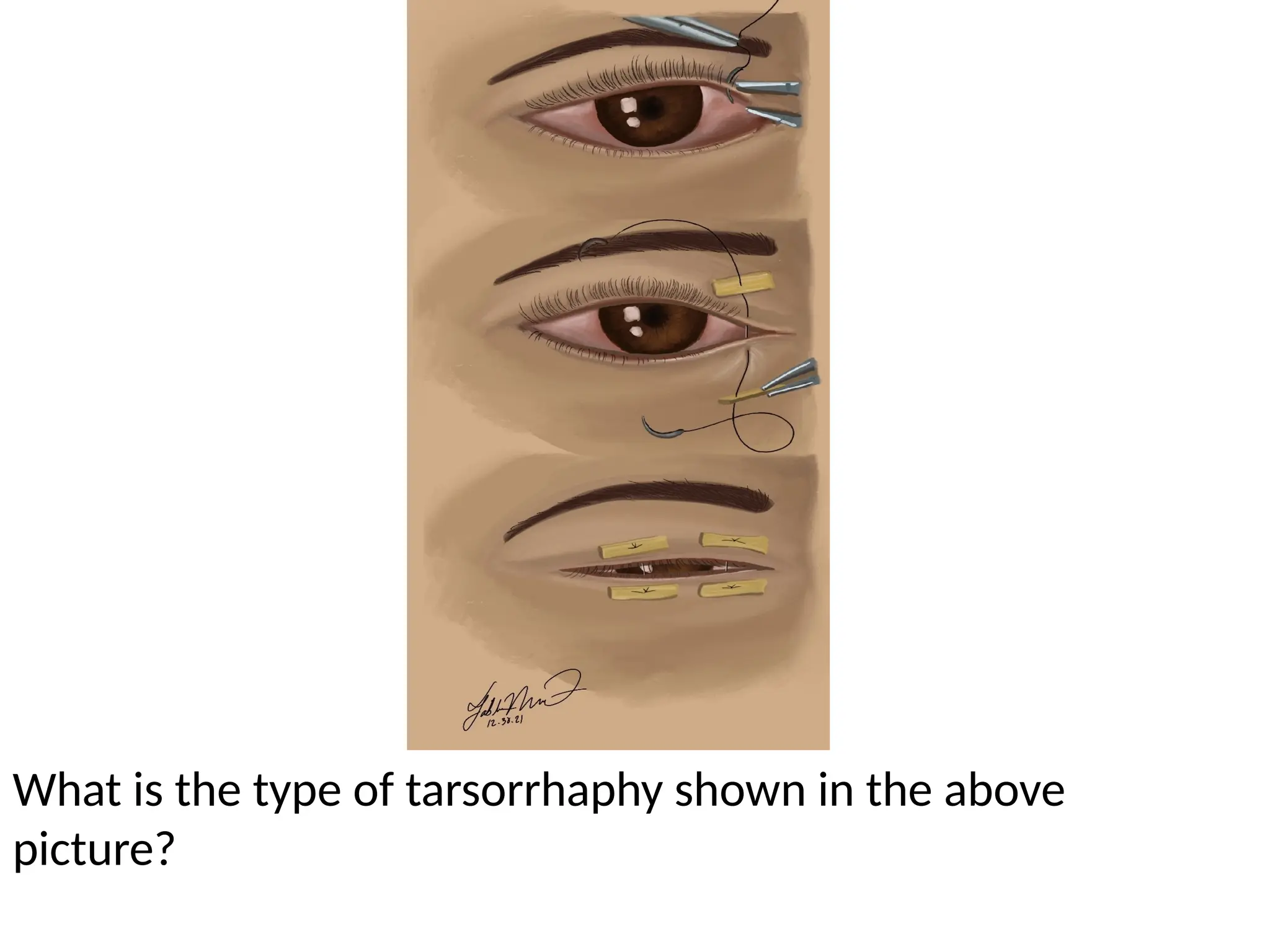 Tarsorrhaphy.pptx........................ | PPTX