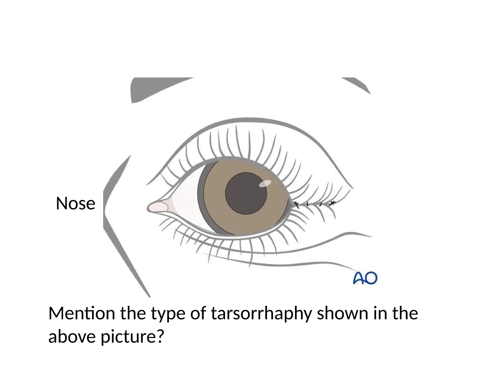 Tarsorrhaphy.pptx........................ | PPTX