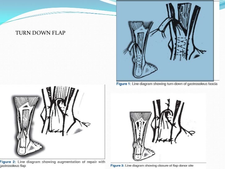 Management of TendoAchillis rupture