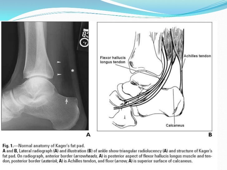 Management of TendoAchillis rupture