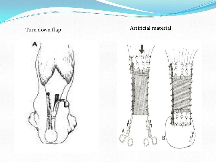 Management of TendoAchillis rupture