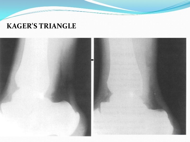 Management of TendoAchillis rupture