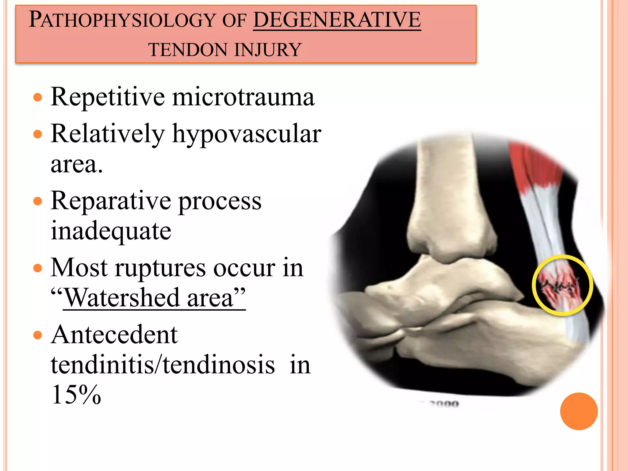 Tendoachilles rupture and its management | PPTX