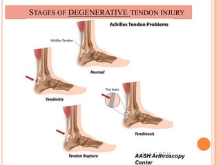 Tendoachilles rupture and its management | PPTX