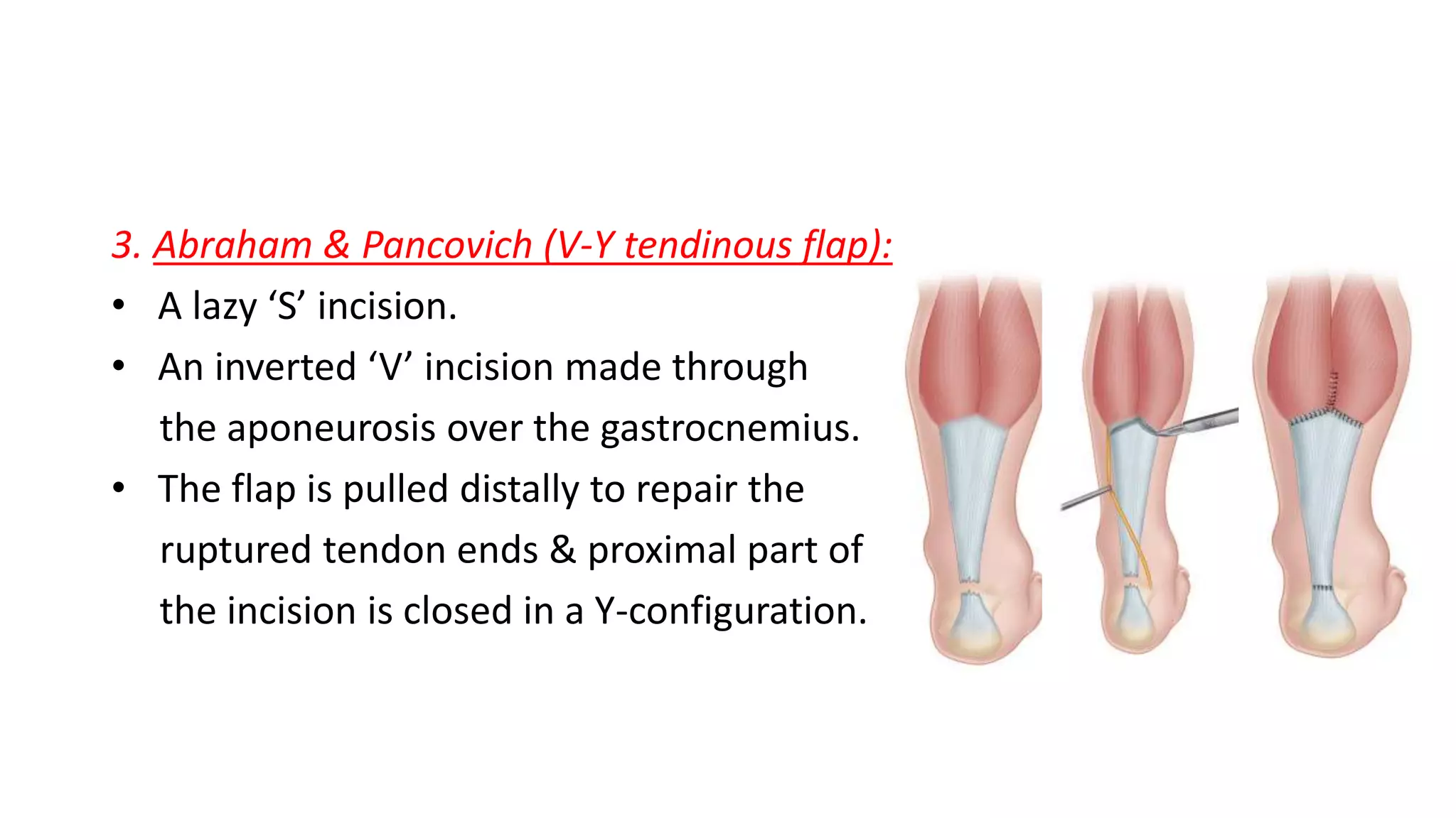 TendoAchilles Rupture | PPTX