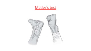 TendoAchilles Rupture | PPTX